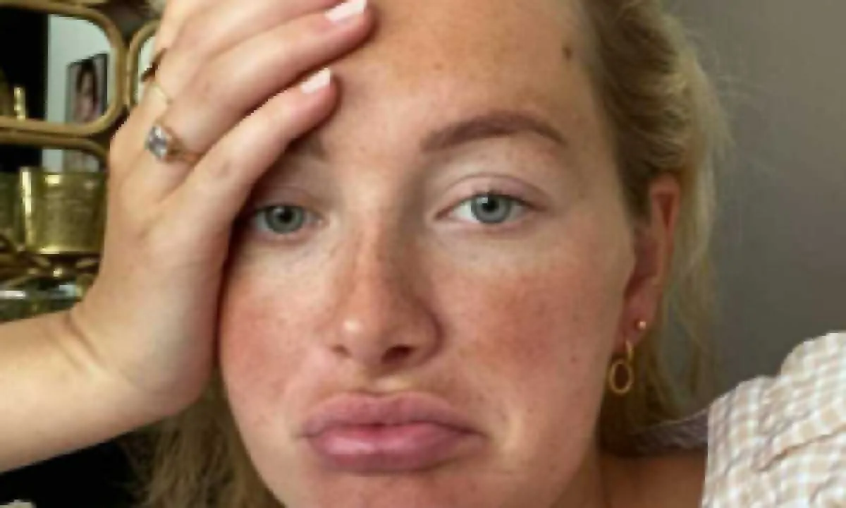 Maxime Meiland showt het resultaat van haar cosmetische ingreep (before ...